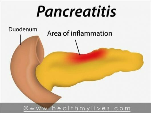Pancreatitis - CAUSAS, Síntomas, TRATOS & PREVENCIÓN