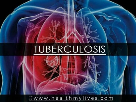 TUBERCULOSIS- 8 Mga sintomas, Sanhi, Paggamot & Pag-iwas