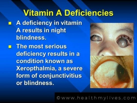 NIGHT BLINDNESS-CAUSES,SYMPTOMS,TREATMENT&PREVENTION